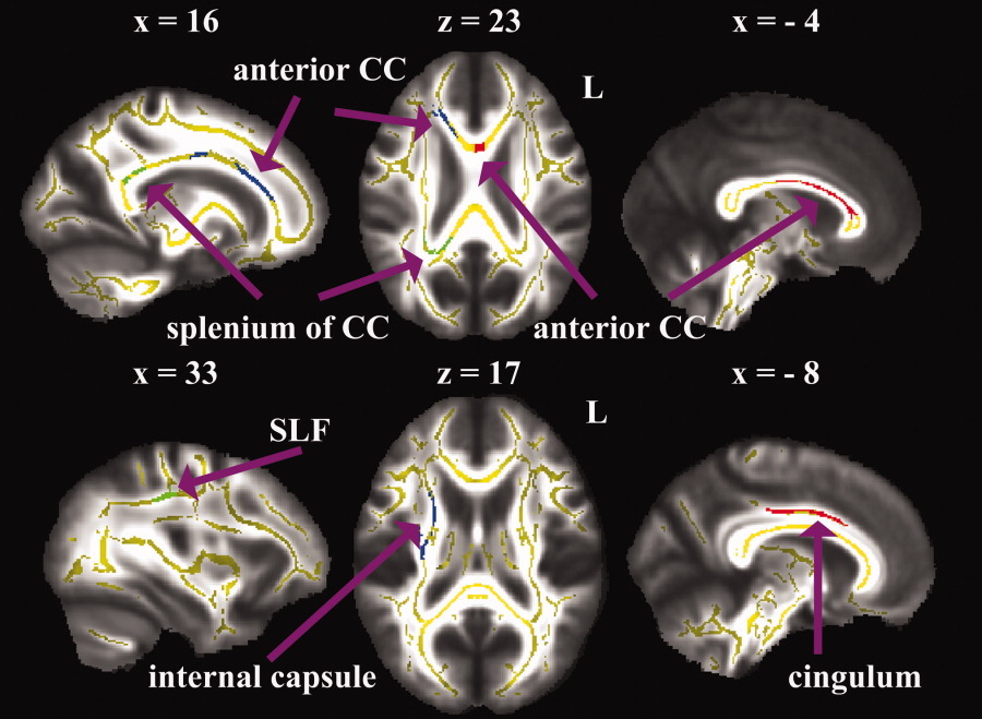 Inferior Frontal White Matter Asymmetry Correlates With Executive